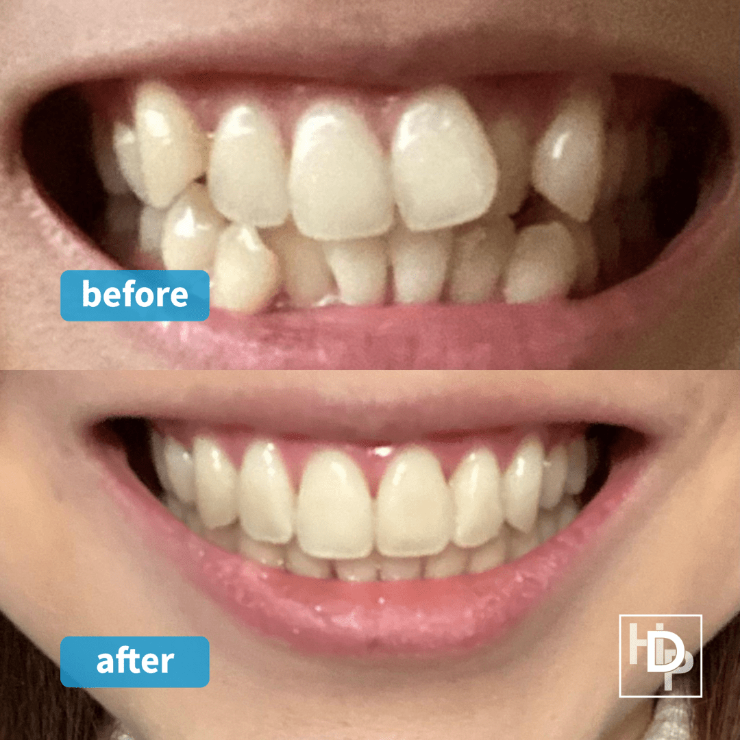 Havelock Dental | Invisalign Open Day in Whitby and Scarborough